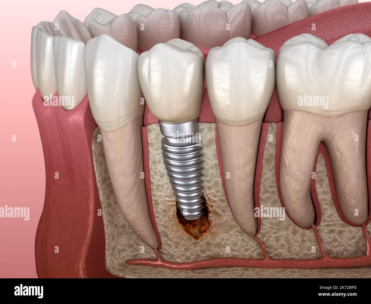Peri implant mucositis hi-res stock photography and images - Alamy