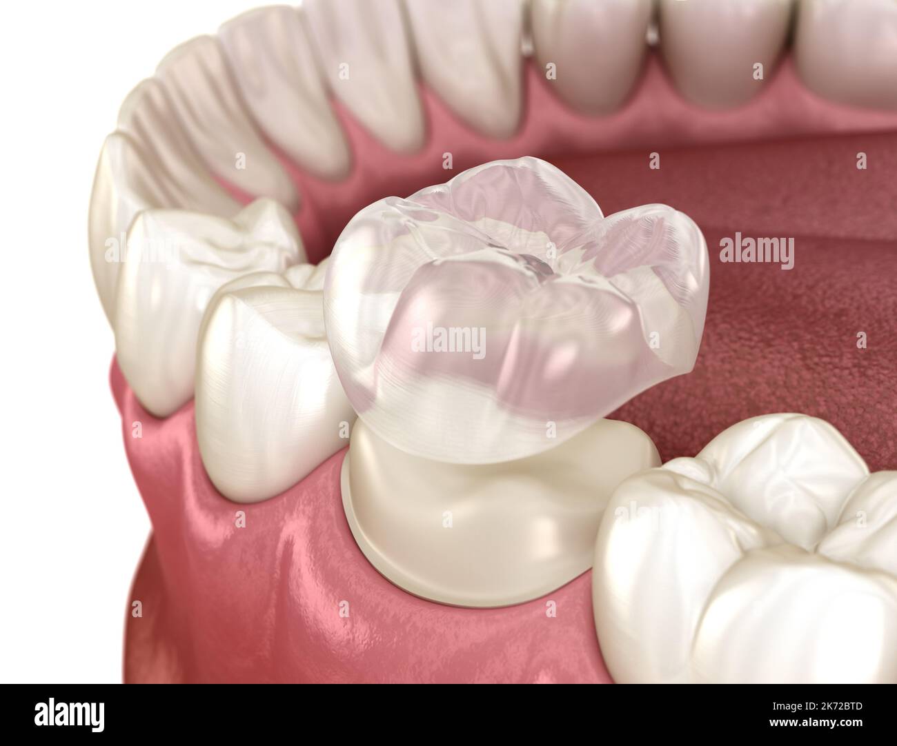 Preparated molar tooth for dental crown placement. Medically accurate ...