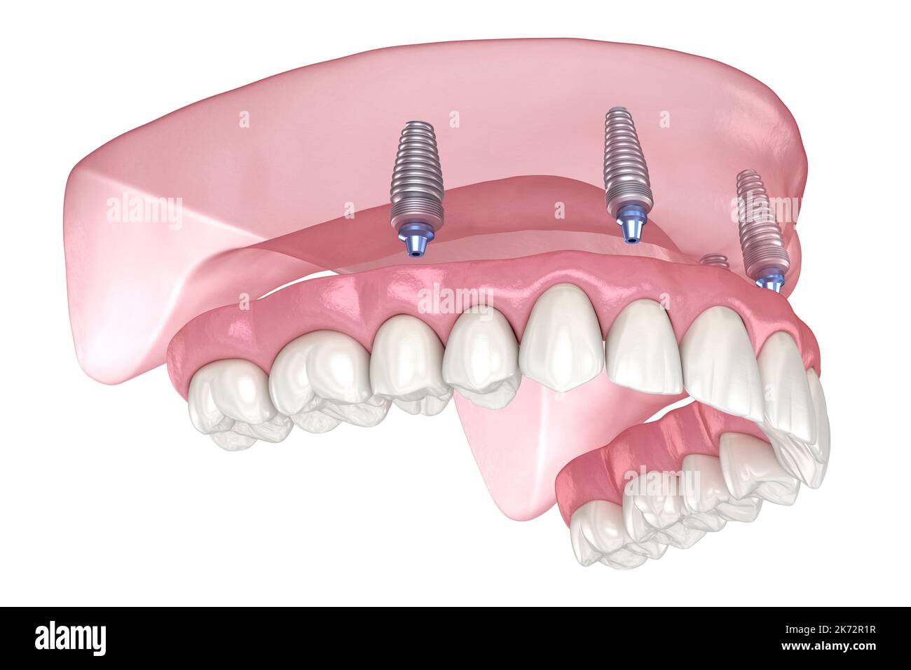 Maxillary prosthesis with gum All on 4 system supported by implants ...