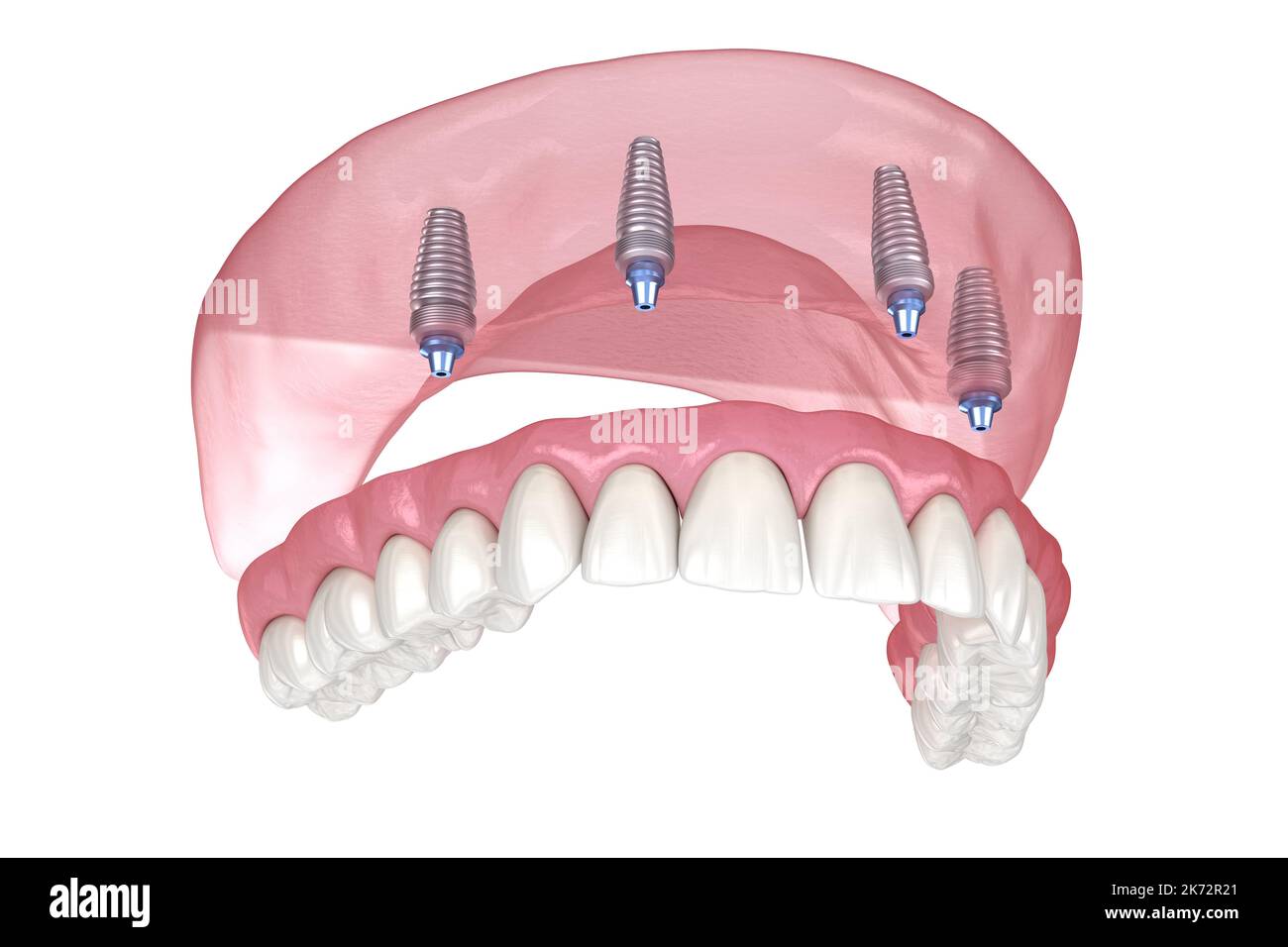 Maxillary prosthesis with gum All on 4 system supported by implants ...