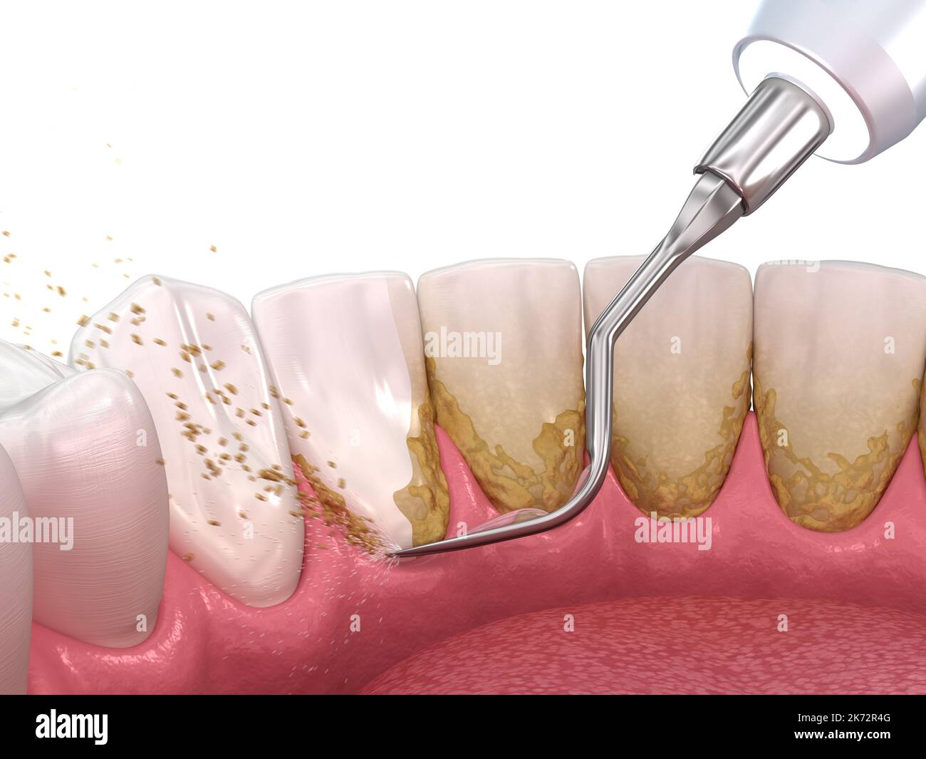 Oral hygiene: Scaling and root planing (conventional periodontal ...