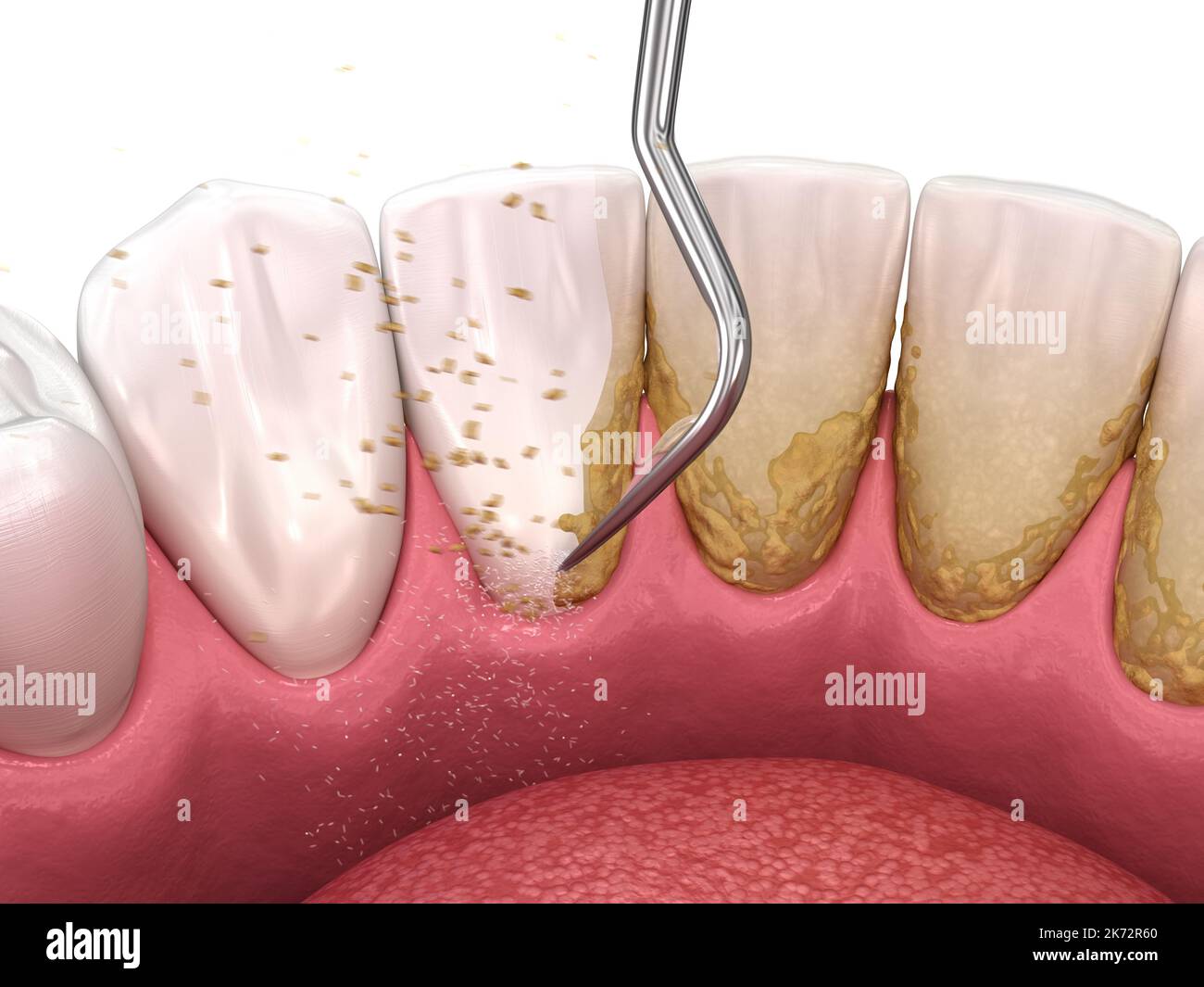 Oral hygiene: Scaling and root planing (conventional periodontal ...