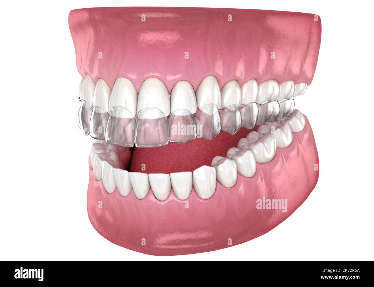 Invisalign braces or invisible retainer. Medically accurate dental 3D ...