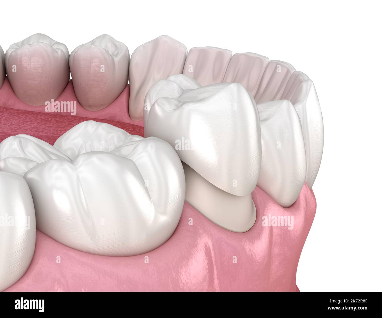 Preparated premolar tooth and dental crown placement. Medically ...