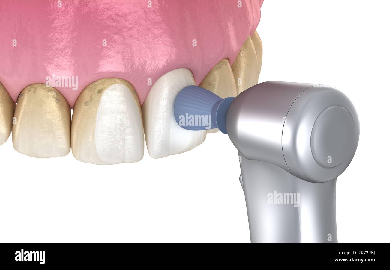 Teeth polishing procedure with professional brush and gel. Medically ...