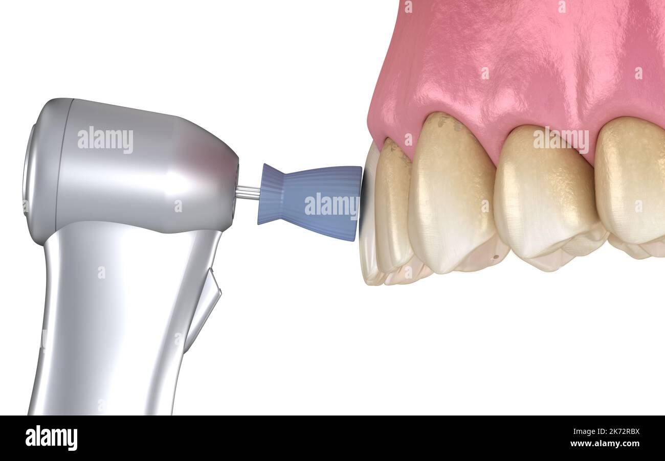 Teeth polishing procedure with professional brush and gel. Medically ...