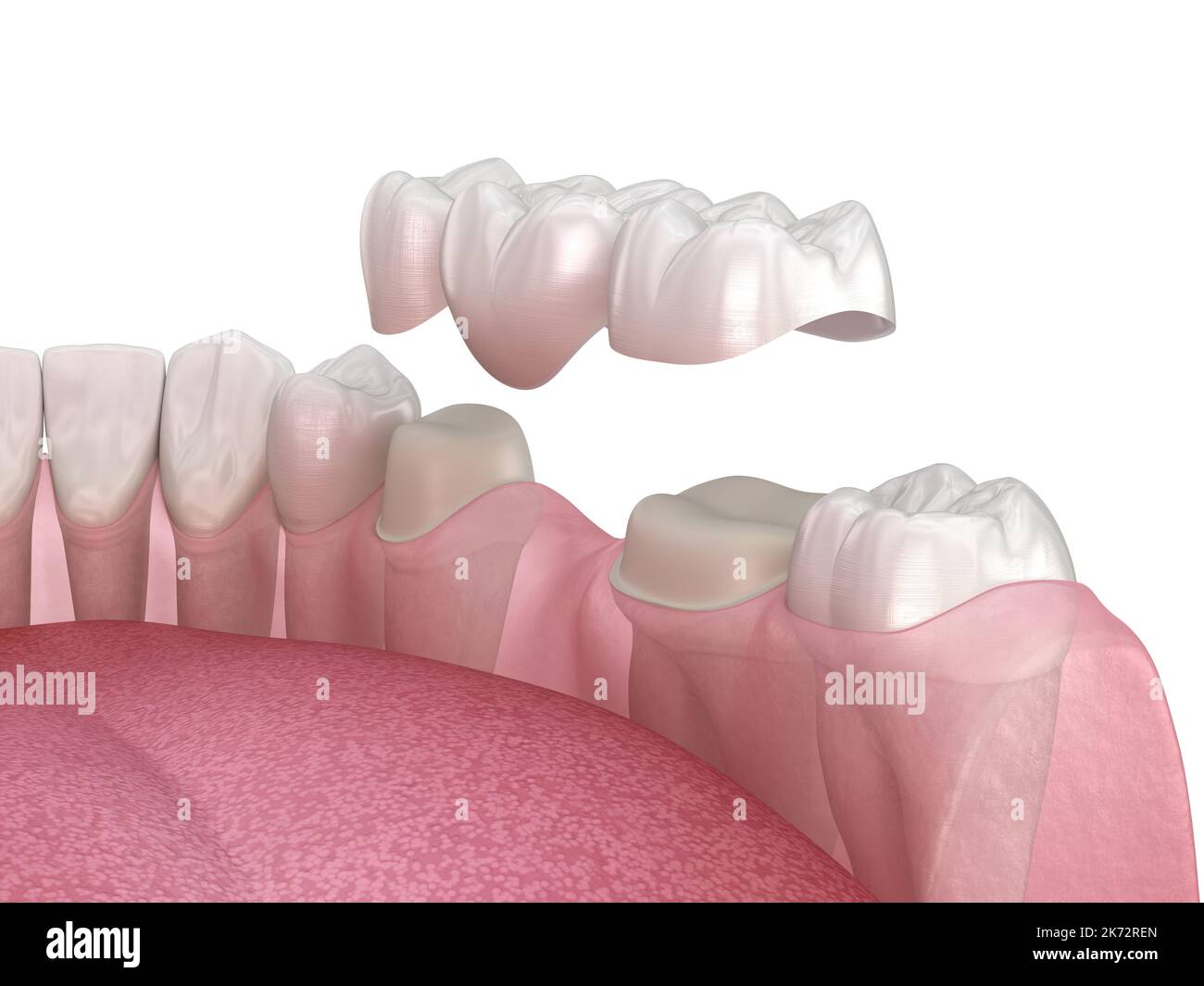 Dental bridge of 3 teeth over molar and premolar. Medically accurate 3D ...