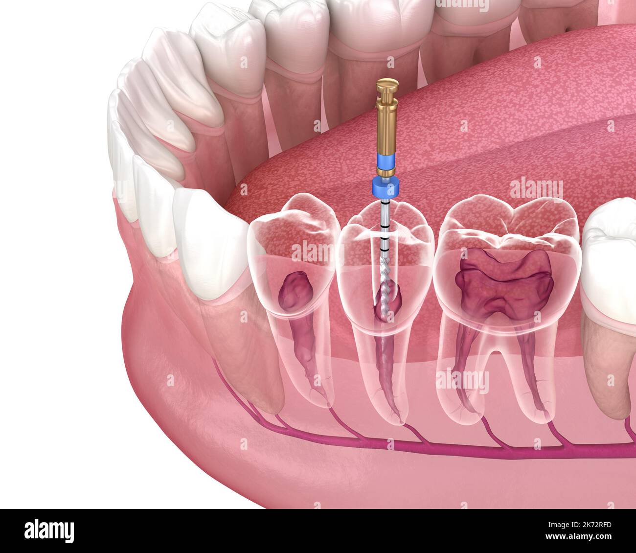 Endodontic root canal treatment process. Medically accurate tooth 3D ...