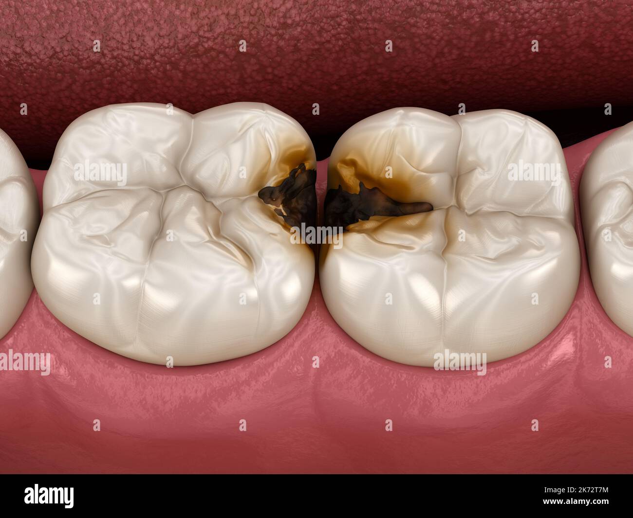 Molar teeth damaged by caries. Medically accurate tooth 3D illustration ...