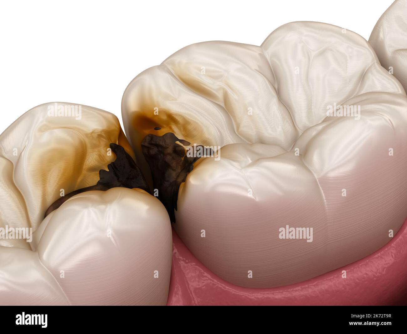 Molar teeth damaged by caries. Medically accurate tooth 3D illustration ...