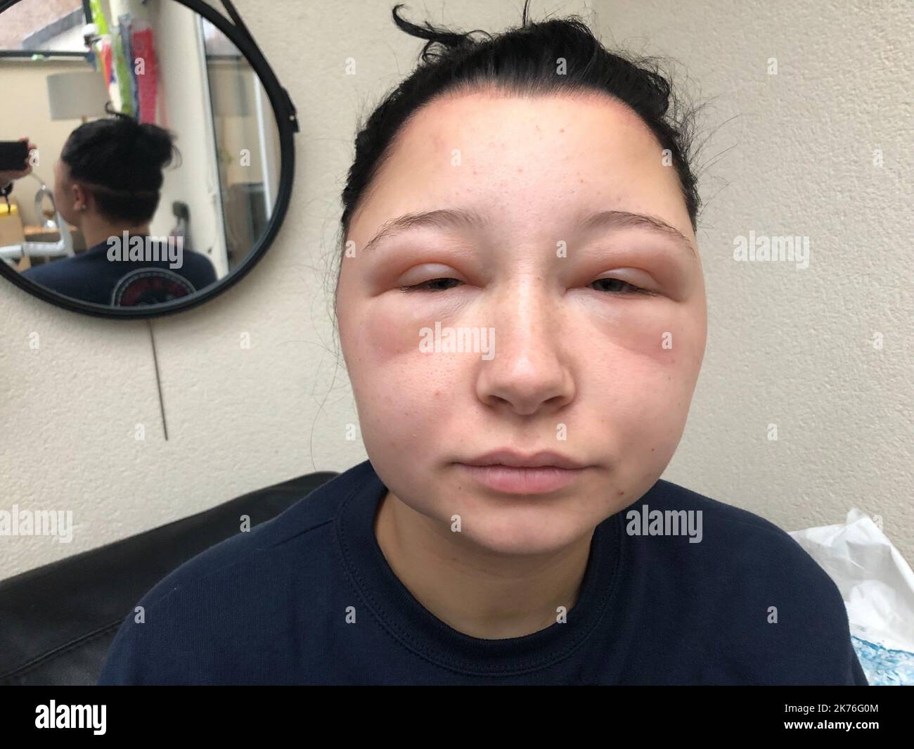 Makeup Allergic Reaction