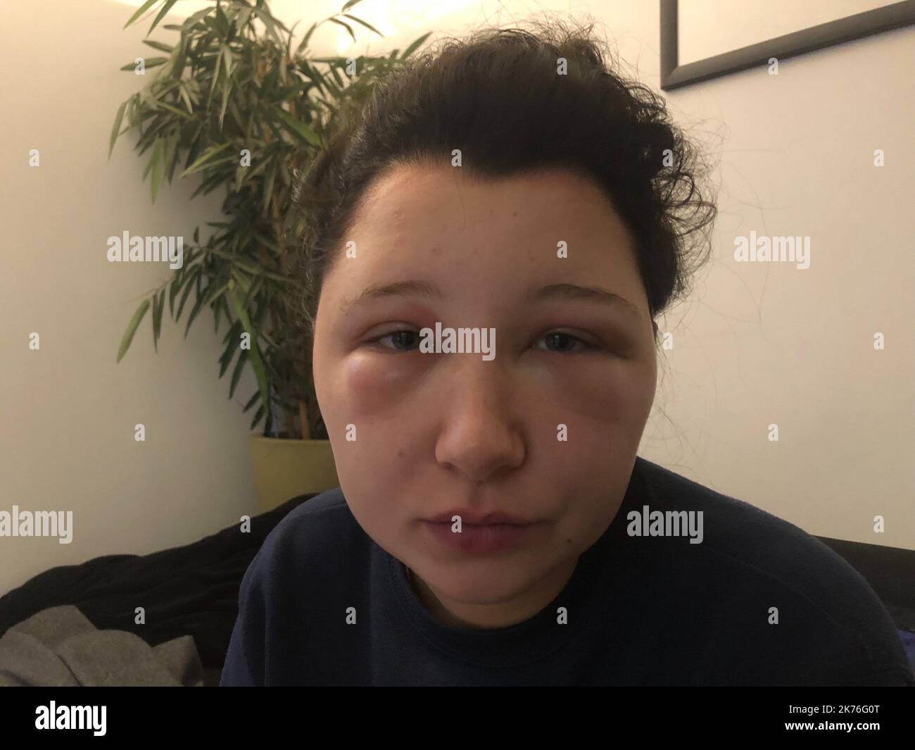 Allergic reaction hair dye hi-res stock photography and images - Alamy