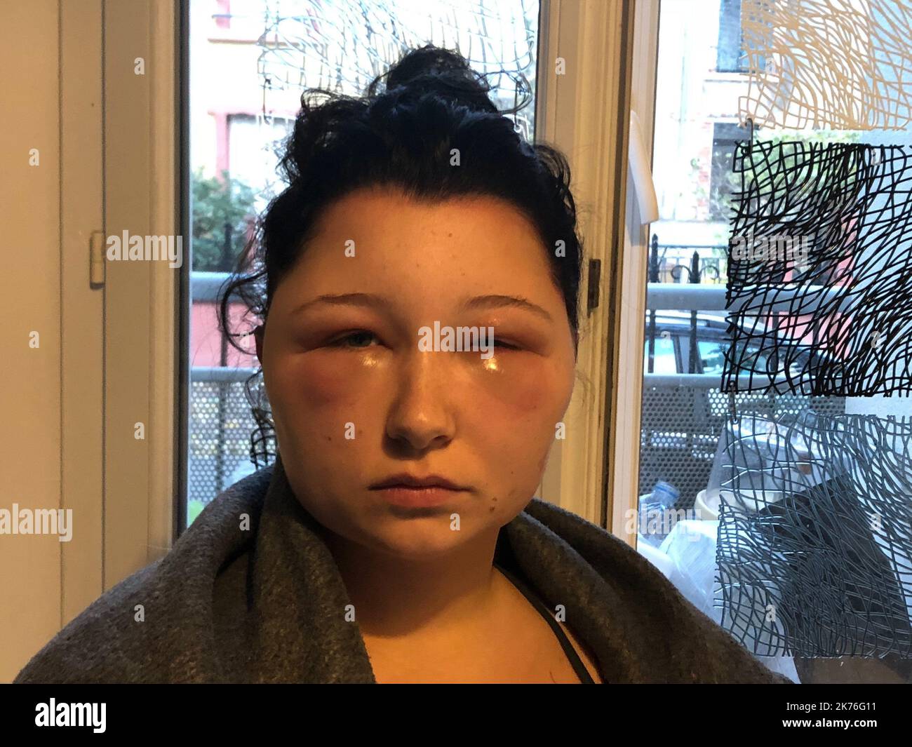 Ppd Hair Dye Reactions