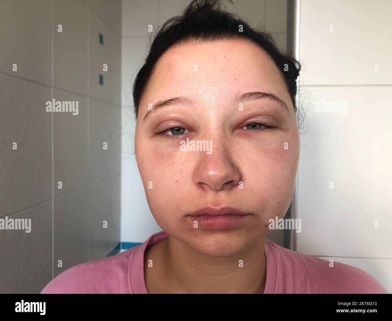 Ppd Hair Dye Reactions