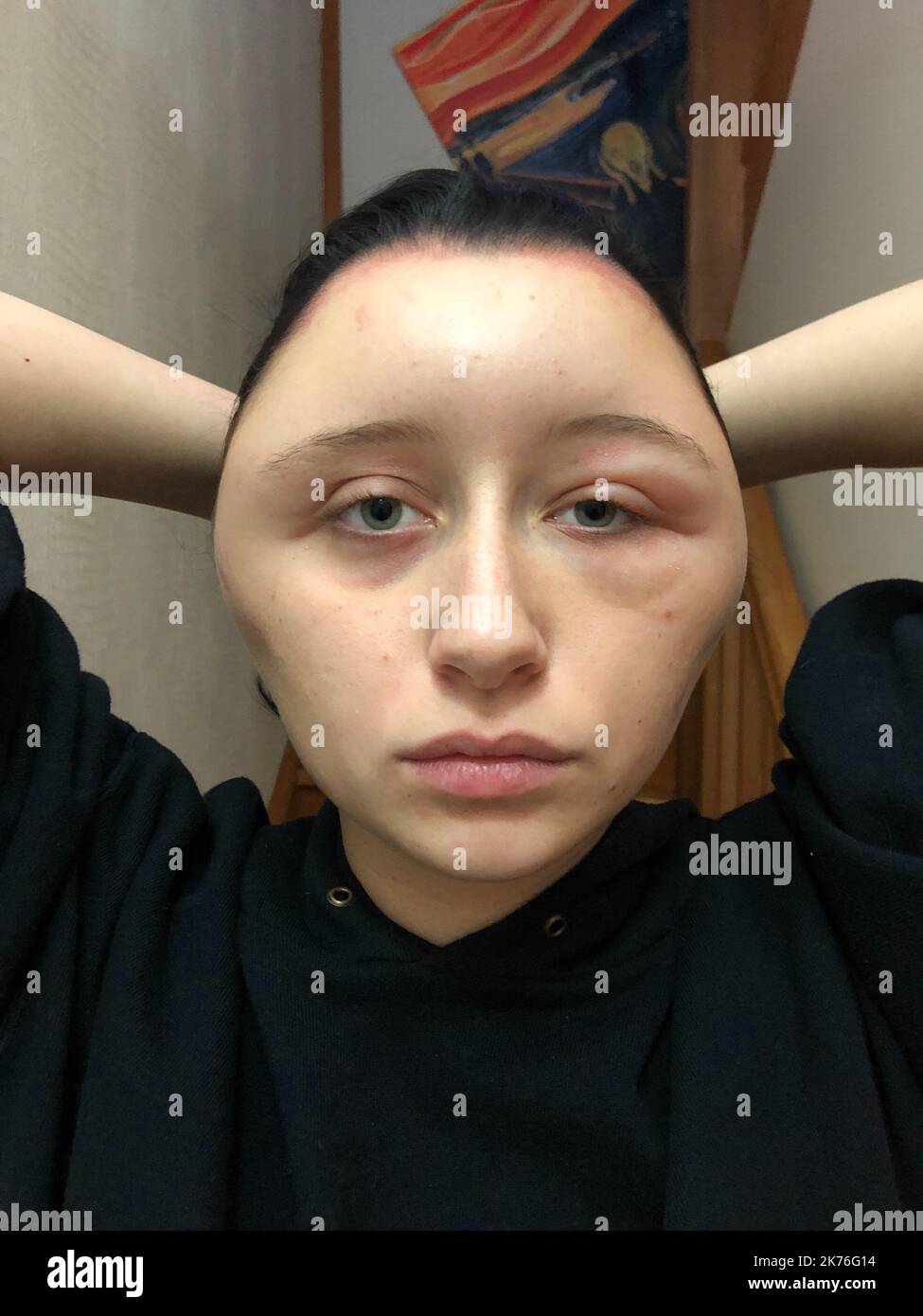 Allergic reaction hair dye hi-res stock photography and images - Alamy