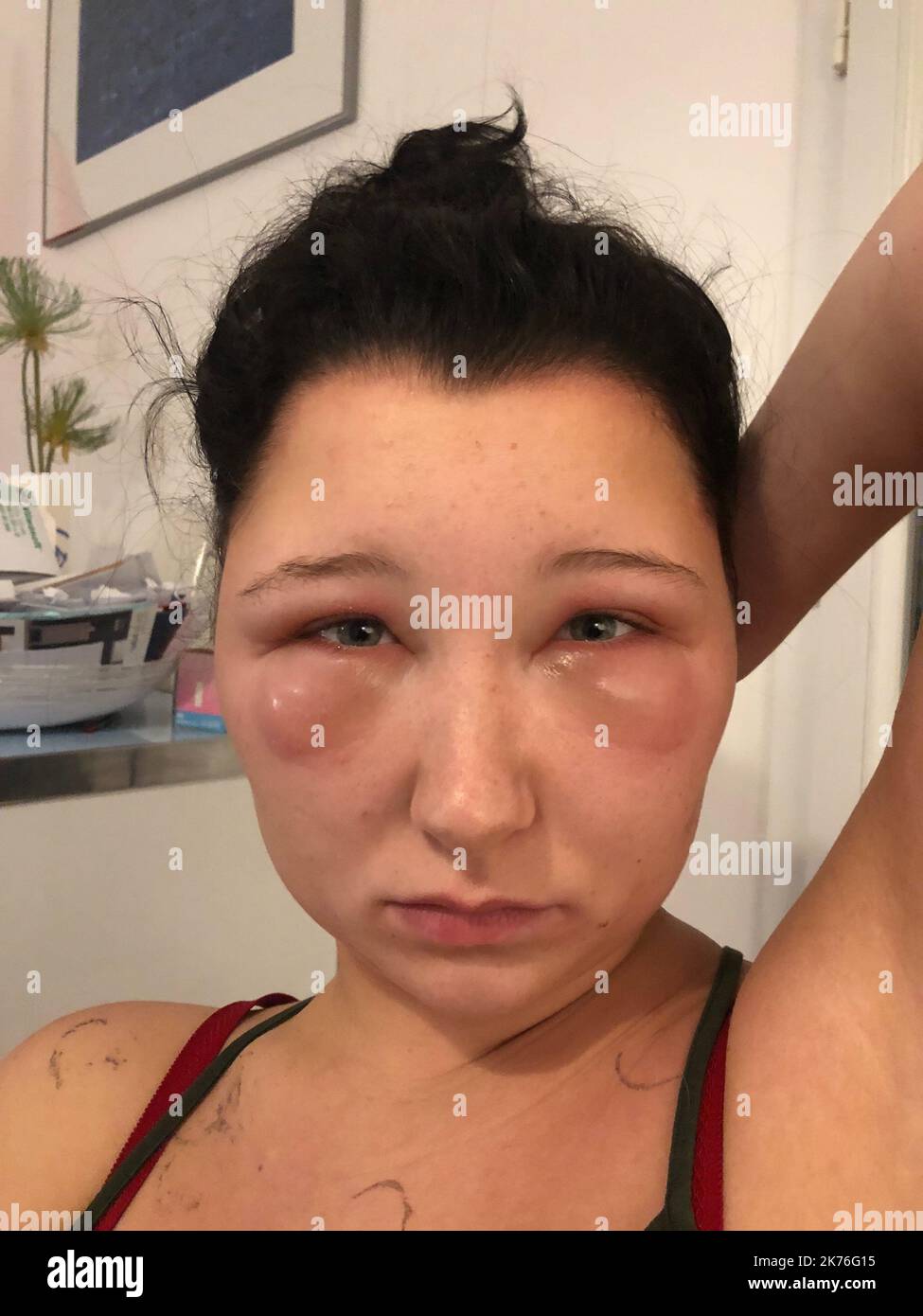 Makeup Allergic Reaction