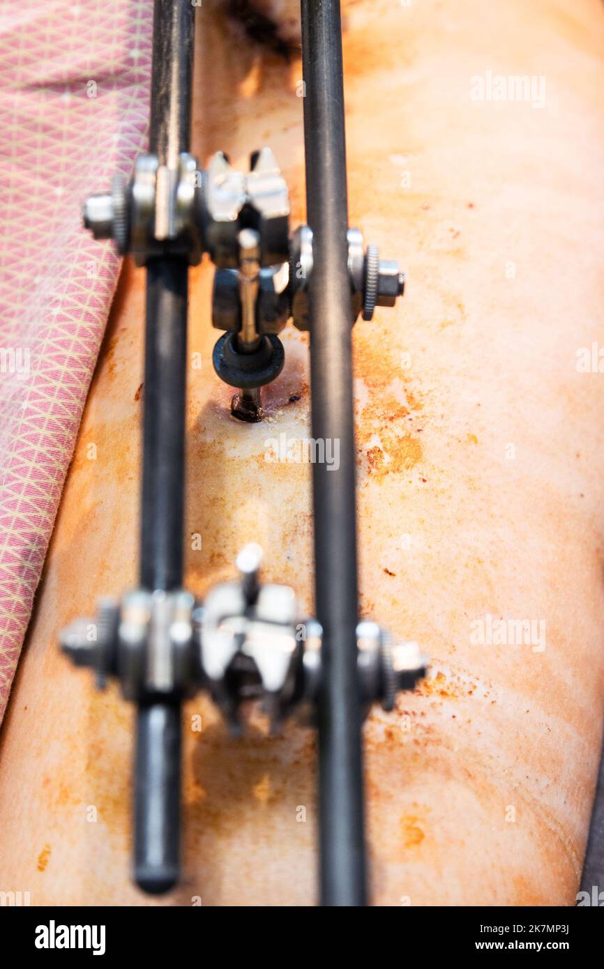 wound in skin from external fixation device on hip close up in patient ...