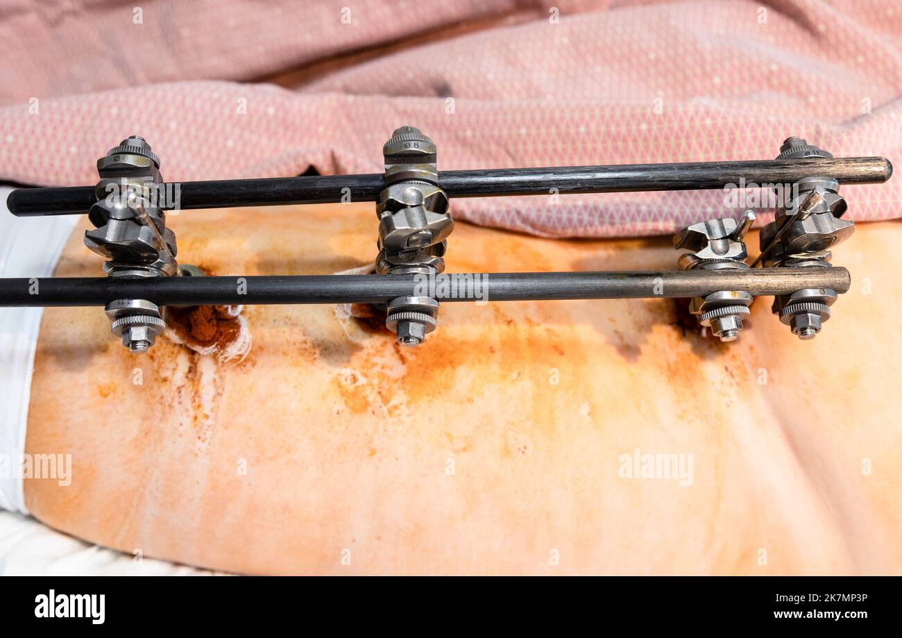 above view of external fixation device on hip and pelvic in patient ...