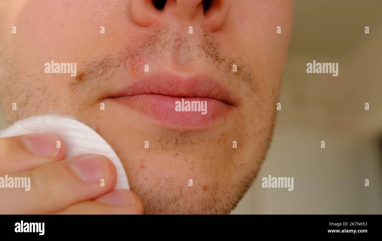 Man with herpes on lips against light grey background. Cold sore on a ...