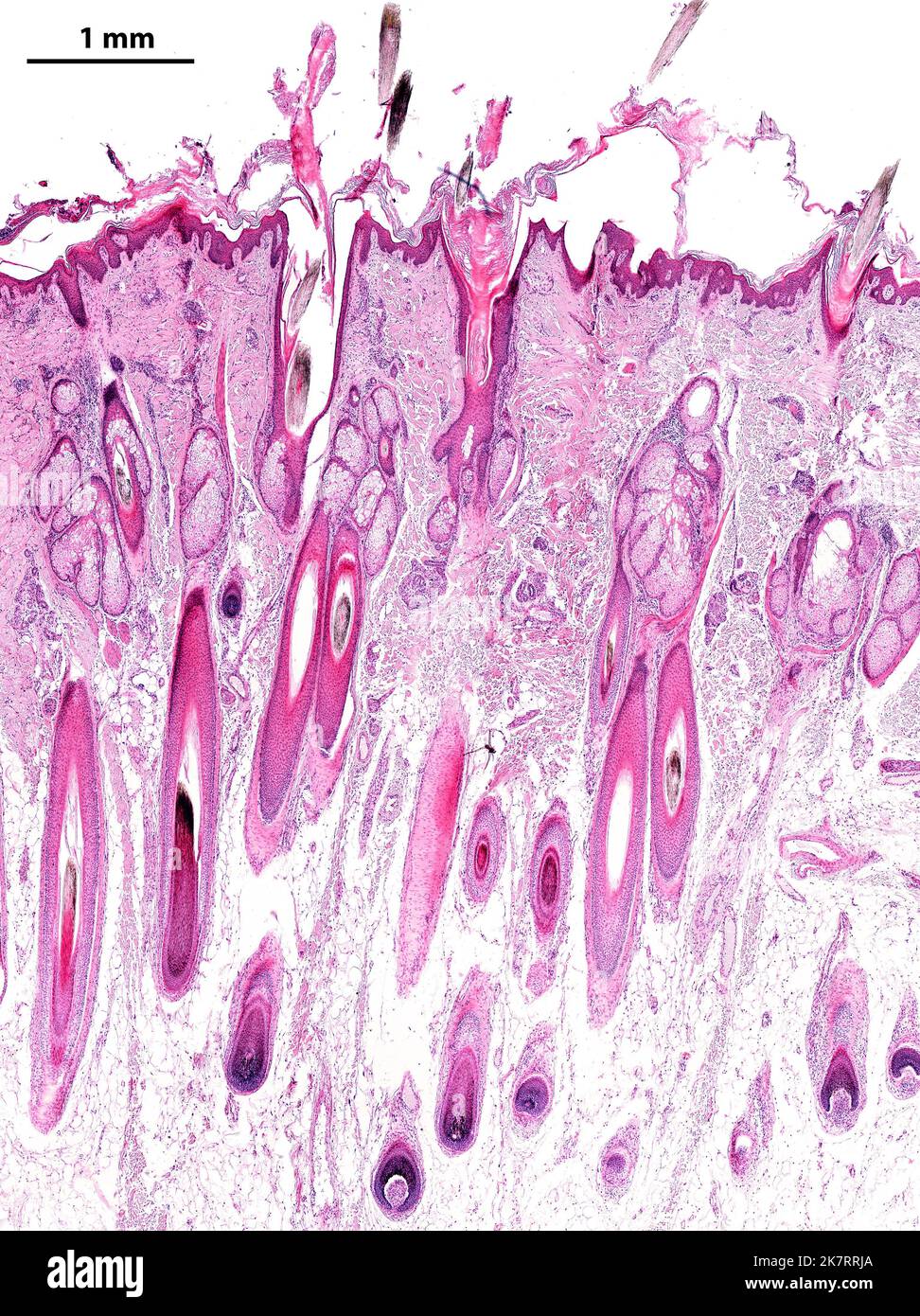 Light micrograph of human scalp skin showing hair follicles ...