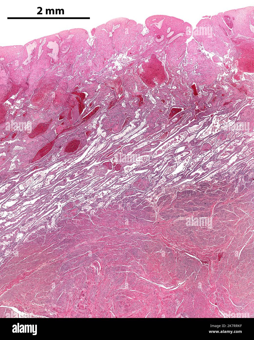 Light micrograph of a human pregnant uterus showing the decidua, a ...