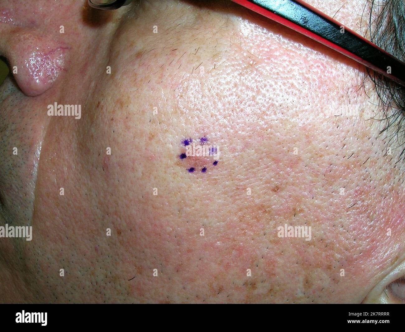 Actinic keratosis on a patient's cheek. This is a precancerous skin ...