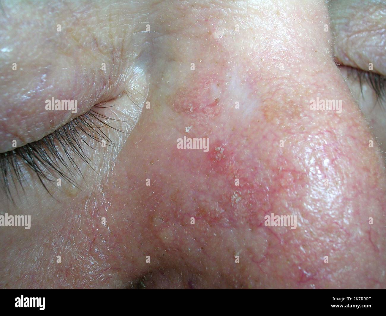 Actinic keratosis on a patient's nose. This is a precancerous skin ...