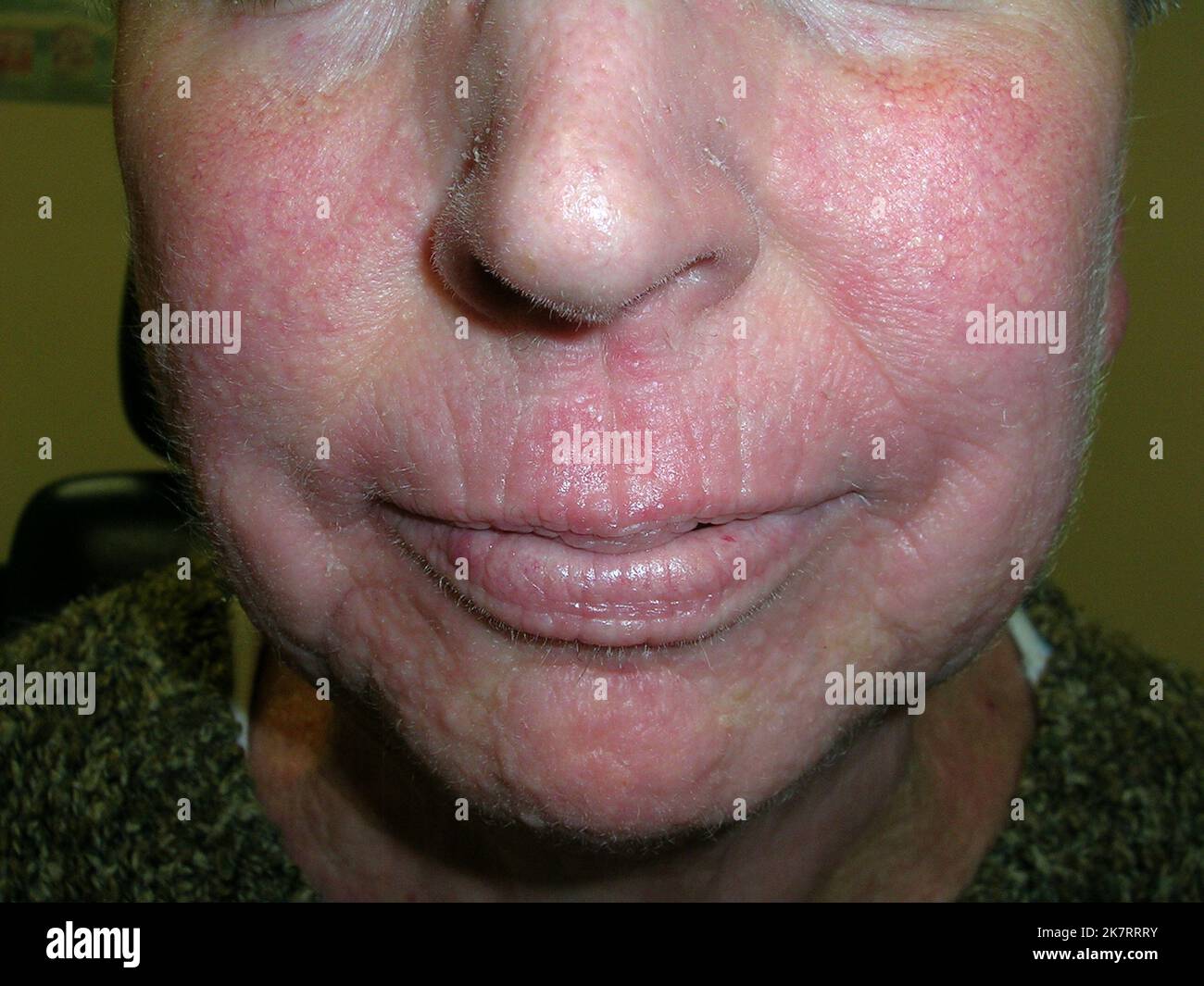 Atopic dermatitis on the face of a white female patient. Atopic ...