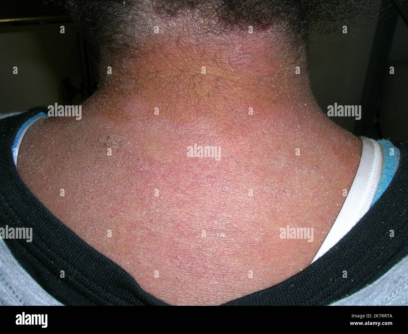 Erythrodermic atopic dermatitis on the back and neck of an African ...