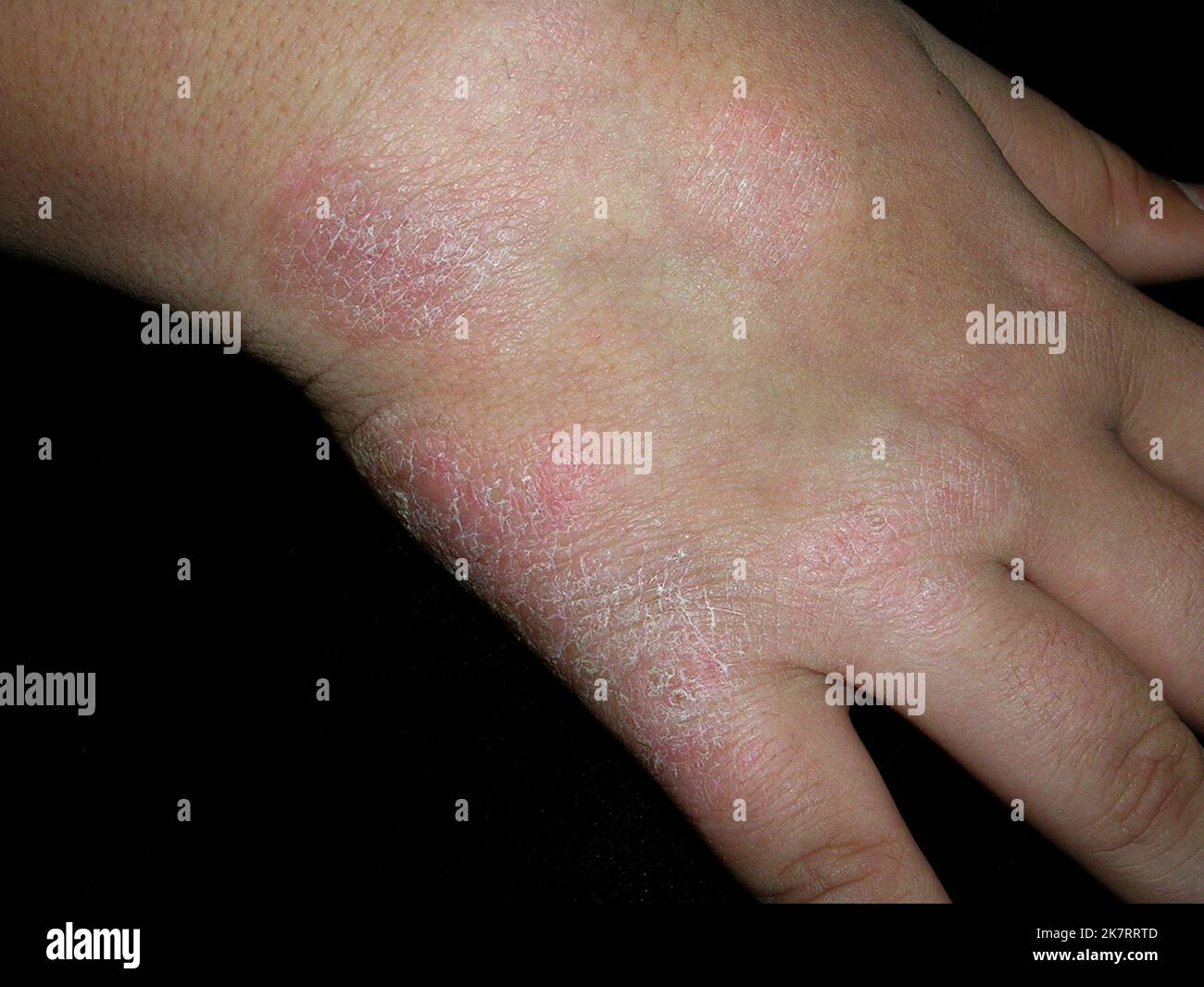 Atopic dermatitis on the hand of an 11 year old Hispanic boy. Atopic ...