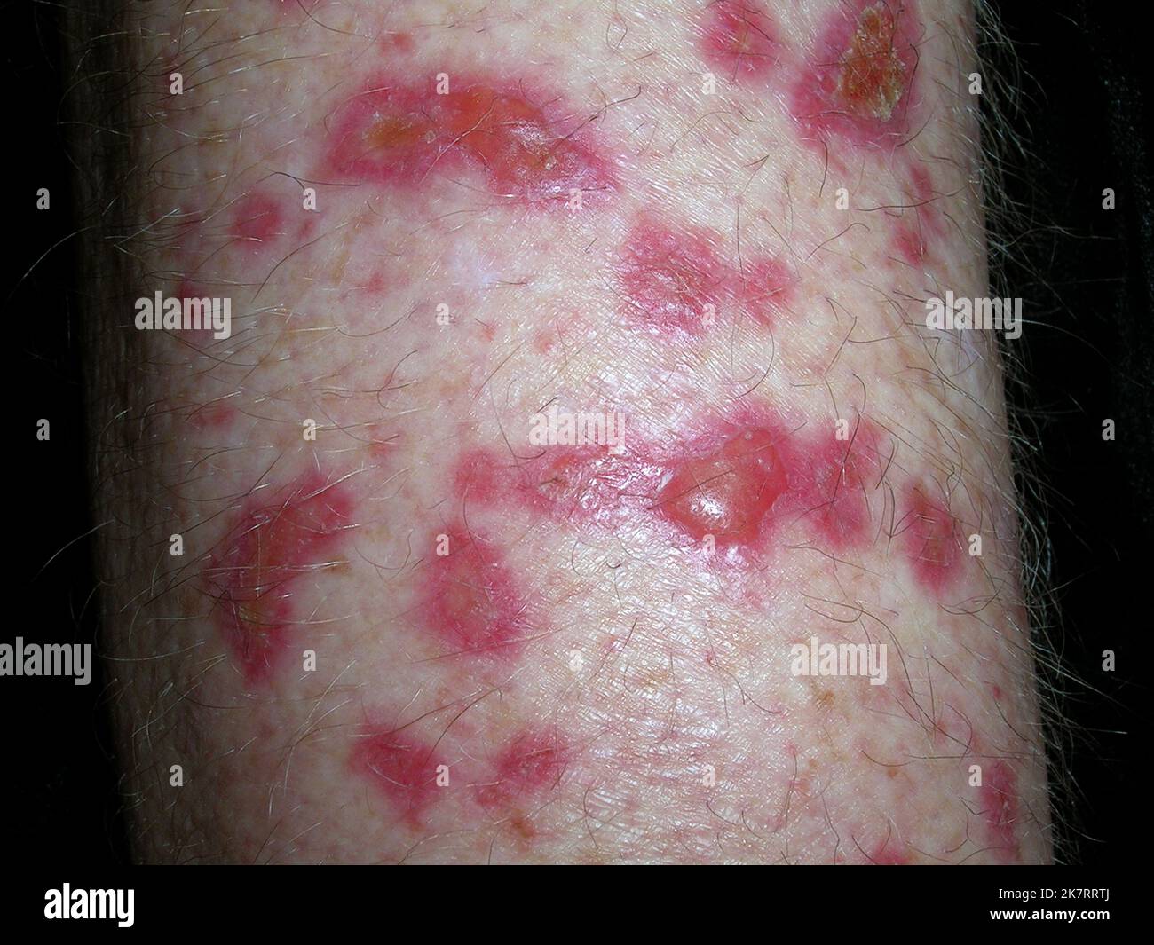 Actinic keratoses on the arm of a 61 year old white male patient ...