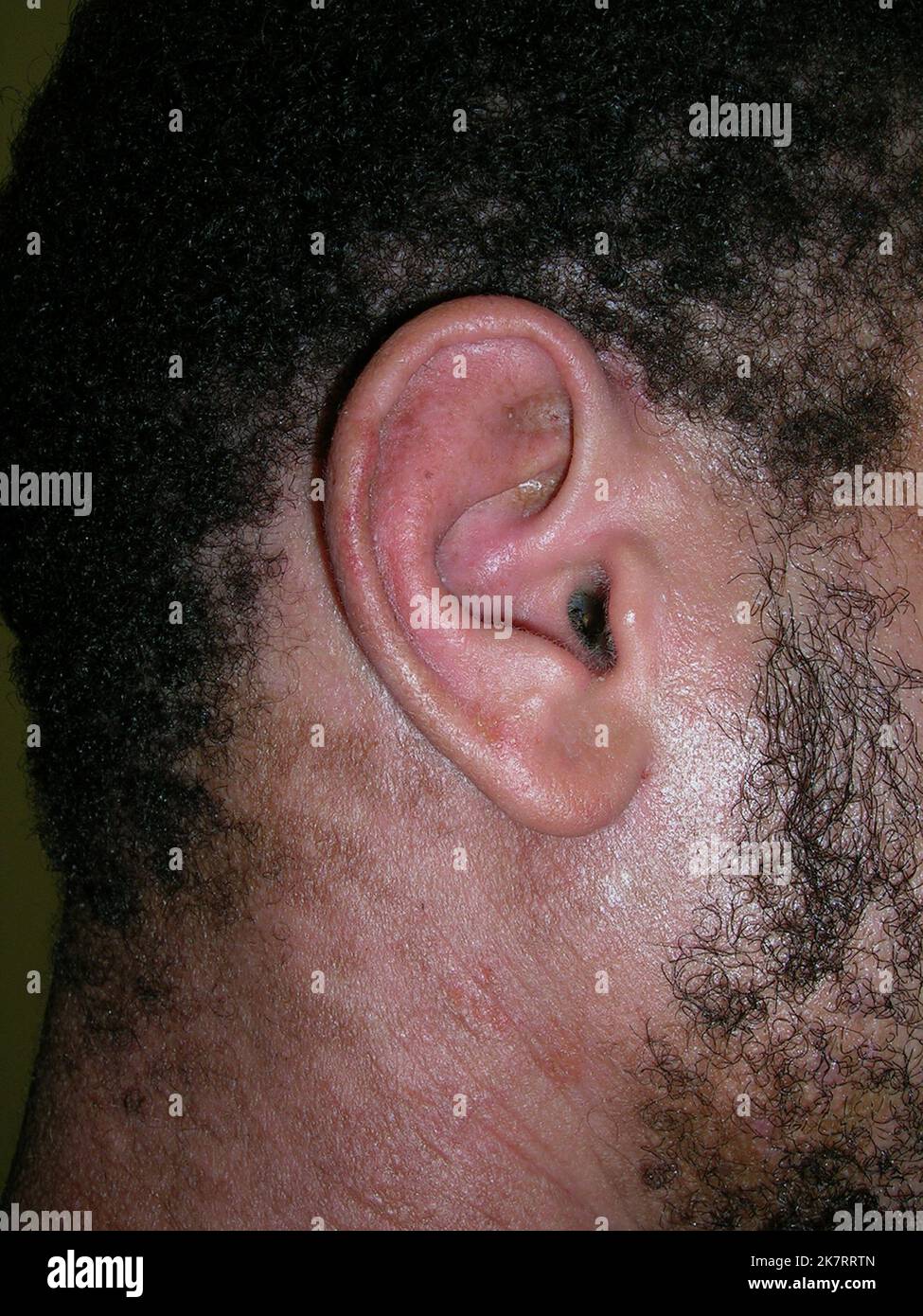 Atopic dermatitis on the ear of a 24 year old African American male ...