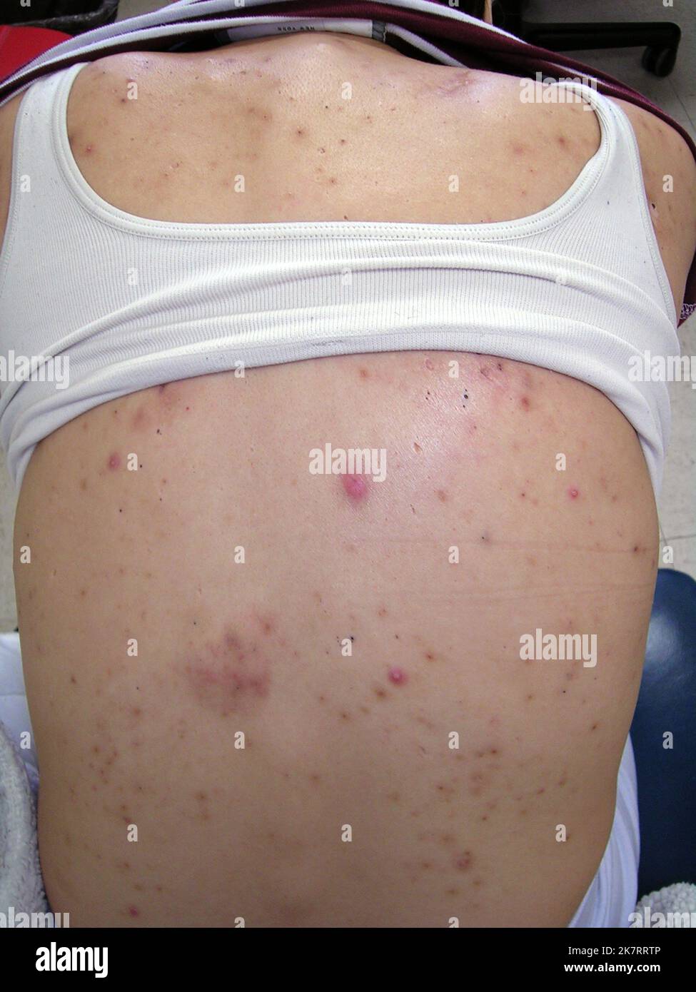 Acne on a patient's back. Acne is a general name given to a skin ...