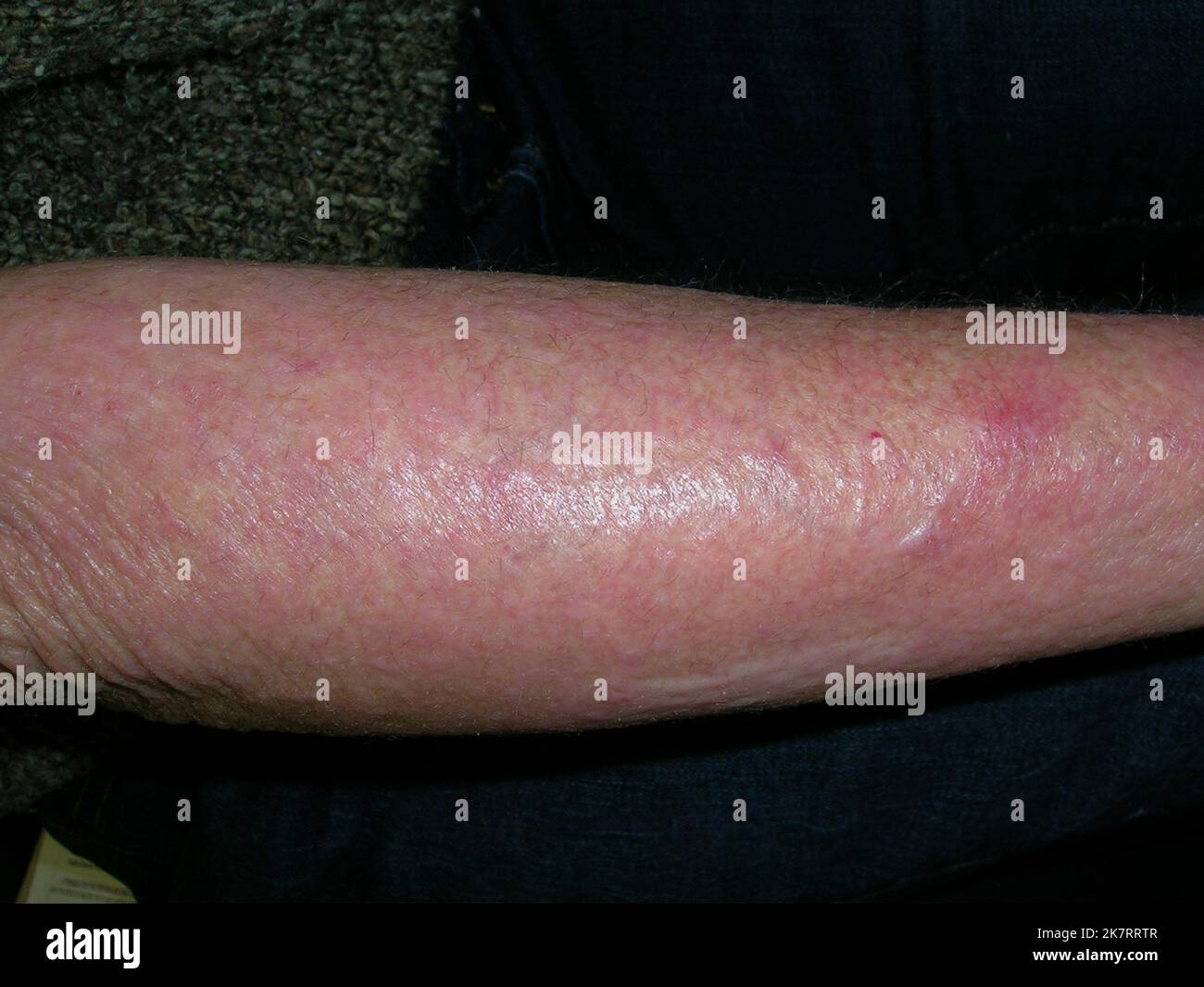 Atopic dermatitis on the arm of a white female patient. Atopic ...