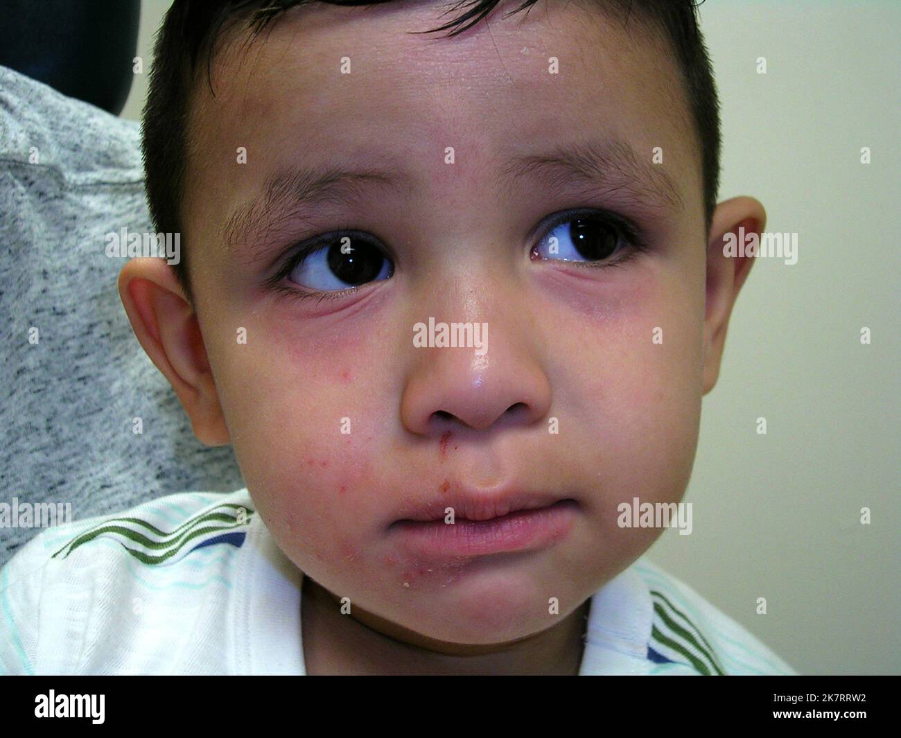 Atopic dermatitis on the face of a young Hispanic boy. Atopic ...