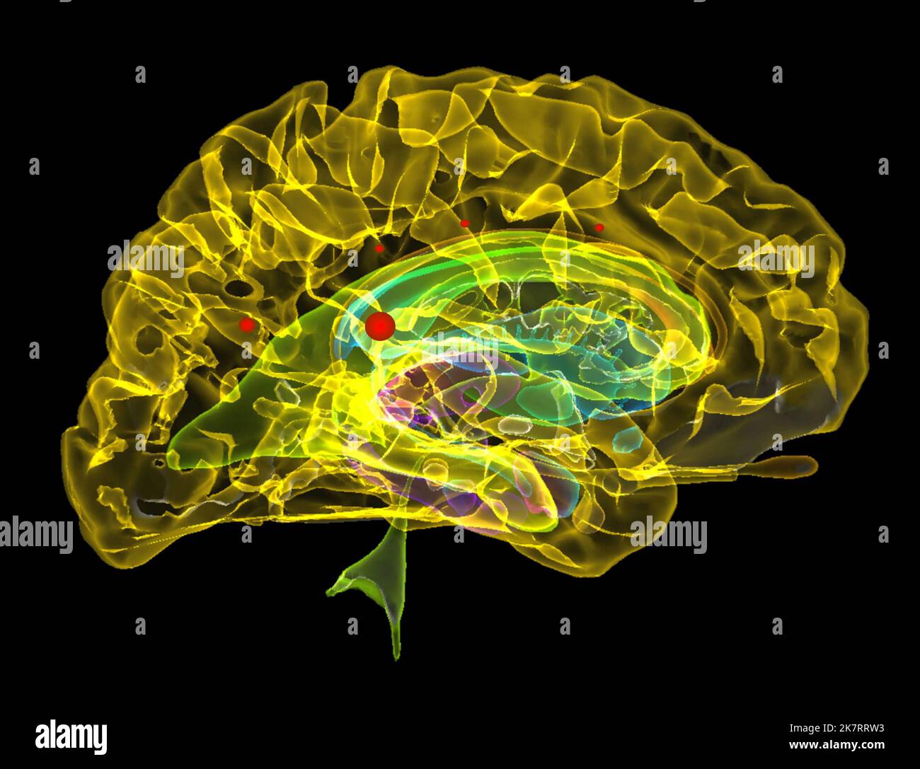 Coloured magnetic resonance imaging (MRI) scan of the brain of a ...