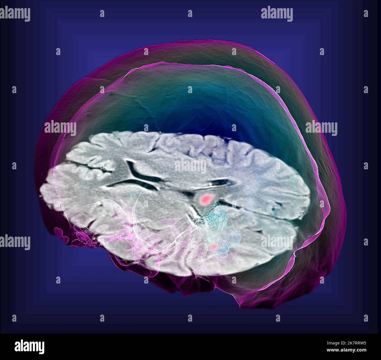 Coloured 2D magnetic resonance imaging (MRI) and 3D computed tomography (CT) scans of the brain ...