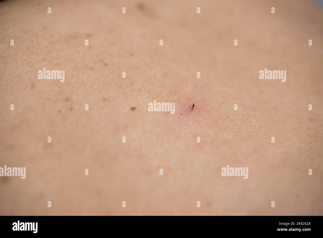 Acne on the back of the skin care woman is caused by bacteria Stock ...