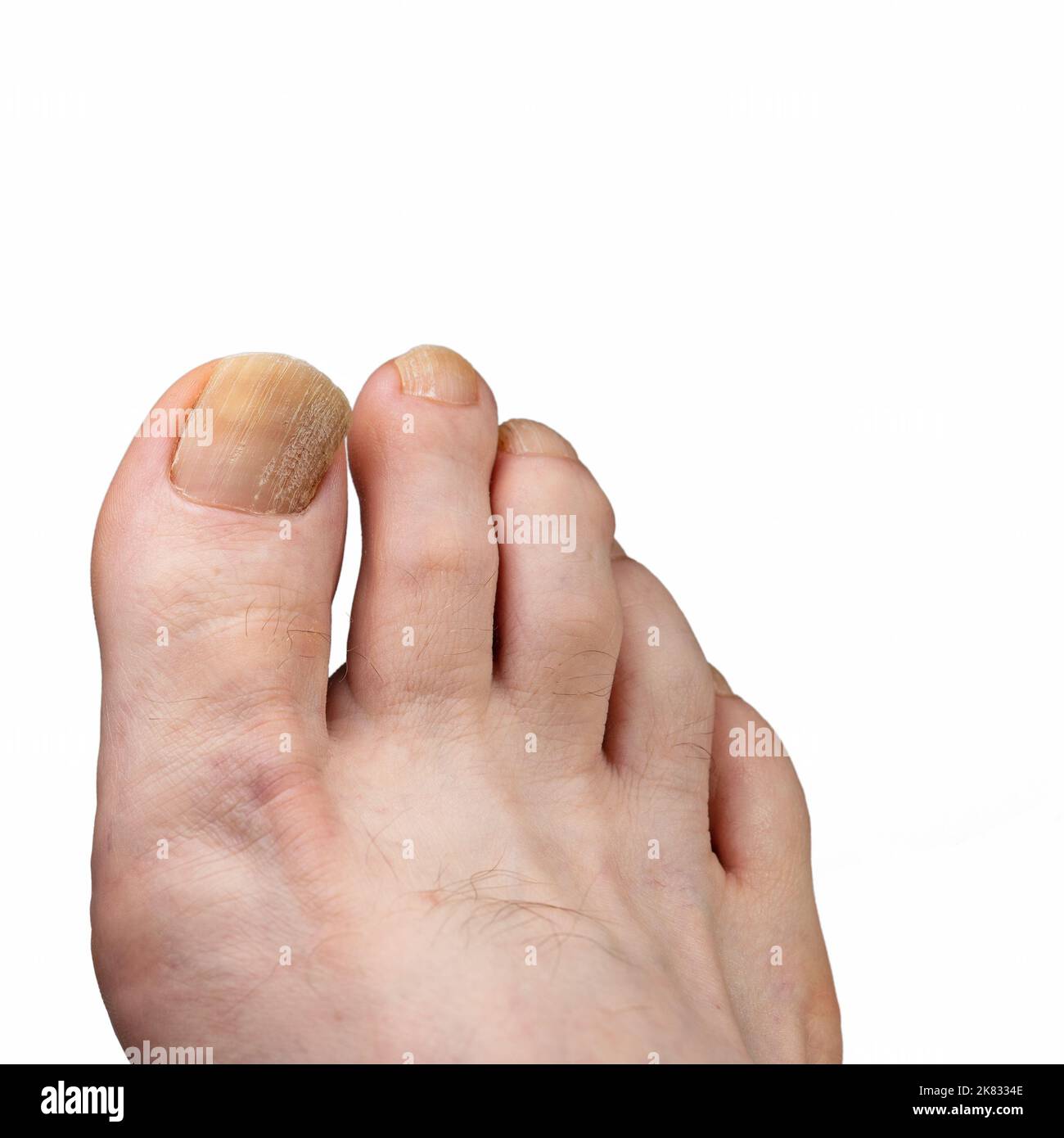 Toenail with nail fungus against white background Stock Photo - Alamy