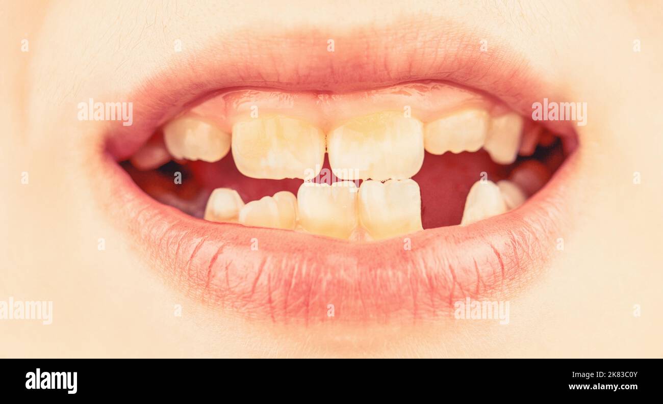 Child smile and show her crowding tooth. Close up of unhealthy baby ...