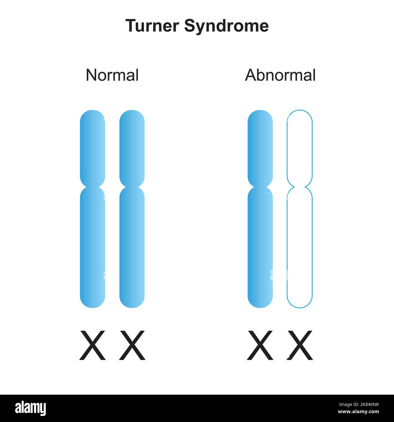 Scientific Designing Of Turner Syndrome Monosomy X Colorful Symbols Vector Illustration