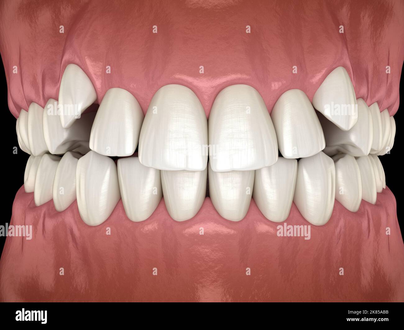 Impacted incisors, overcrowded teeth. Medically accurate 3D ...