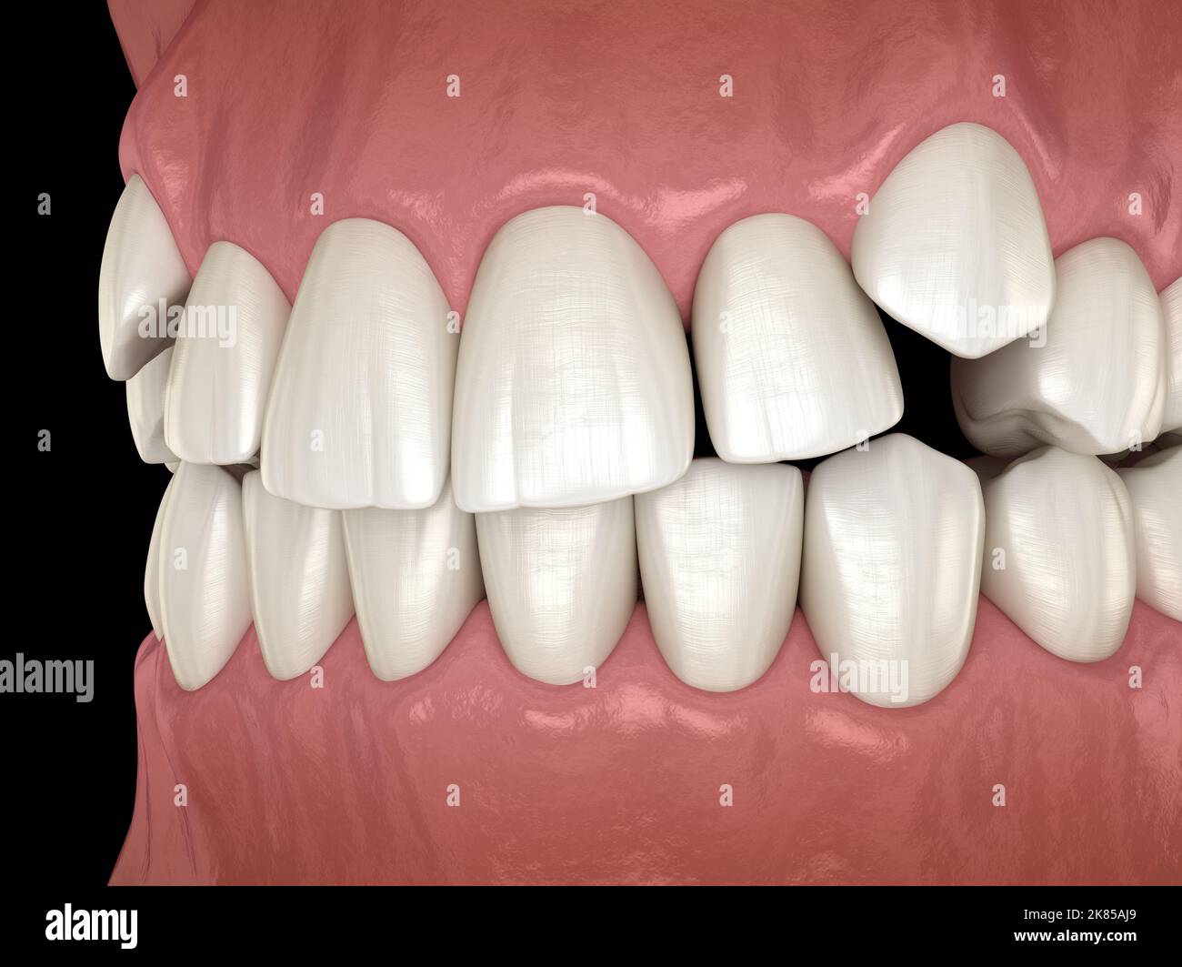 Impacted incisors, overcrowded teeth. Medically accurate 3D ...