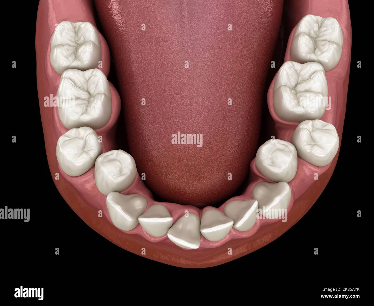 Overcrowded teeth, abnormal dental occlusion. Medically accurate tooth ...