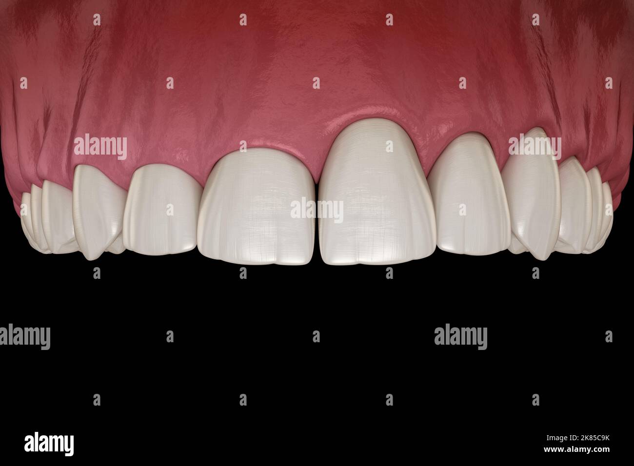 Gingivectomy surgery with laser using. Medically accurate tooth 3D ...