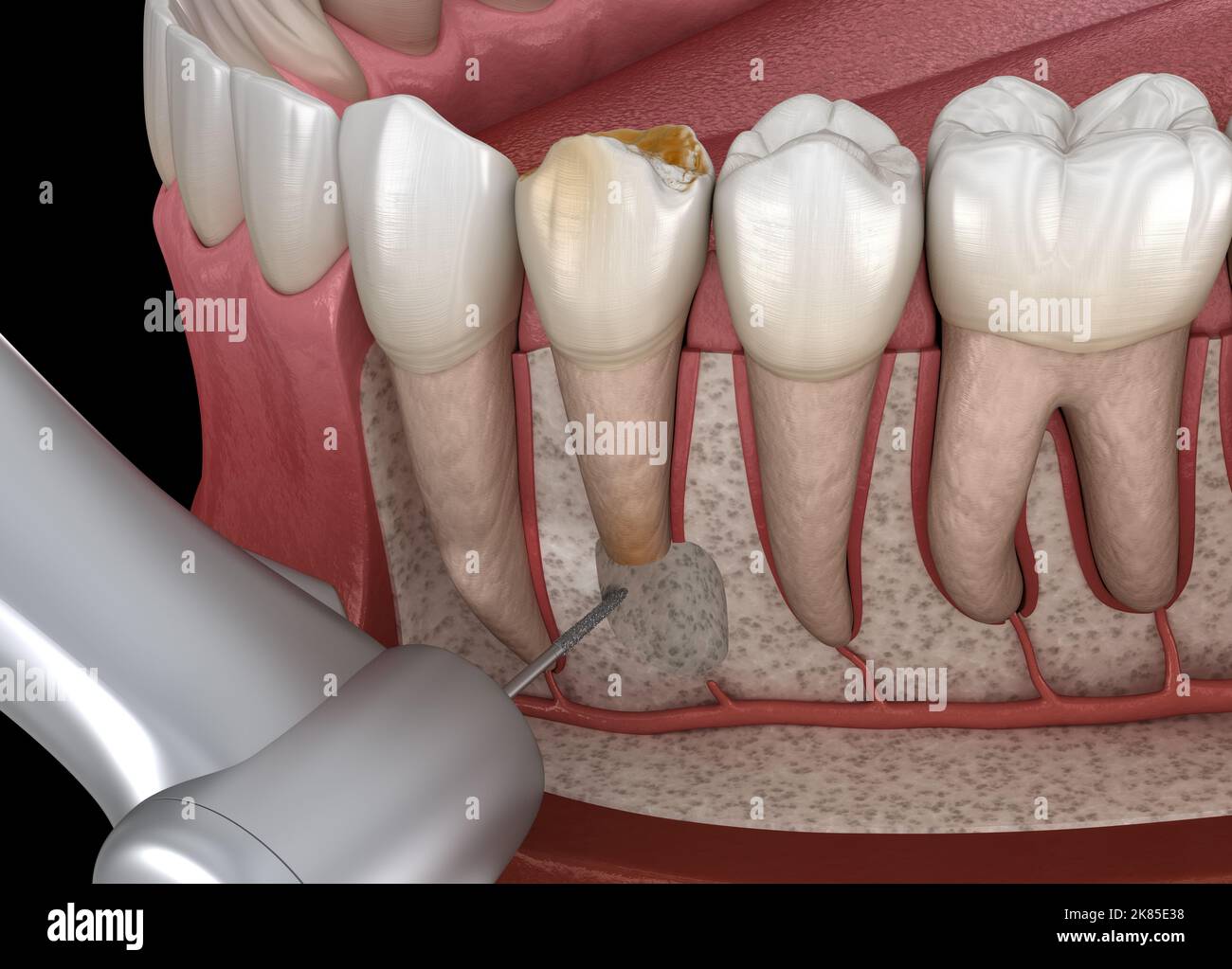 Tooth Cystectomy Surgery - recovery after Periostitis . Medically ...