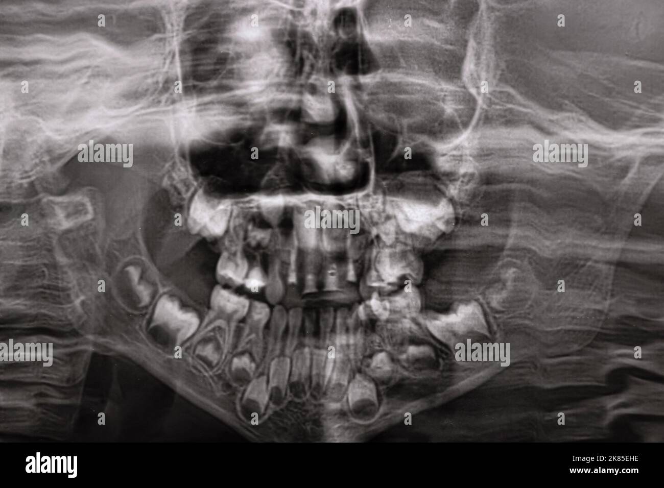 A panoramic X-ray shows several embedded and impacted teeth on both the ...
