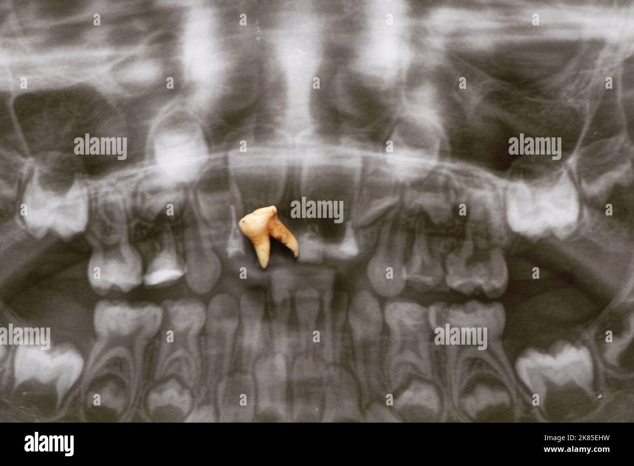 The panoramic image shows several embedded and impacted teeth as on the ...