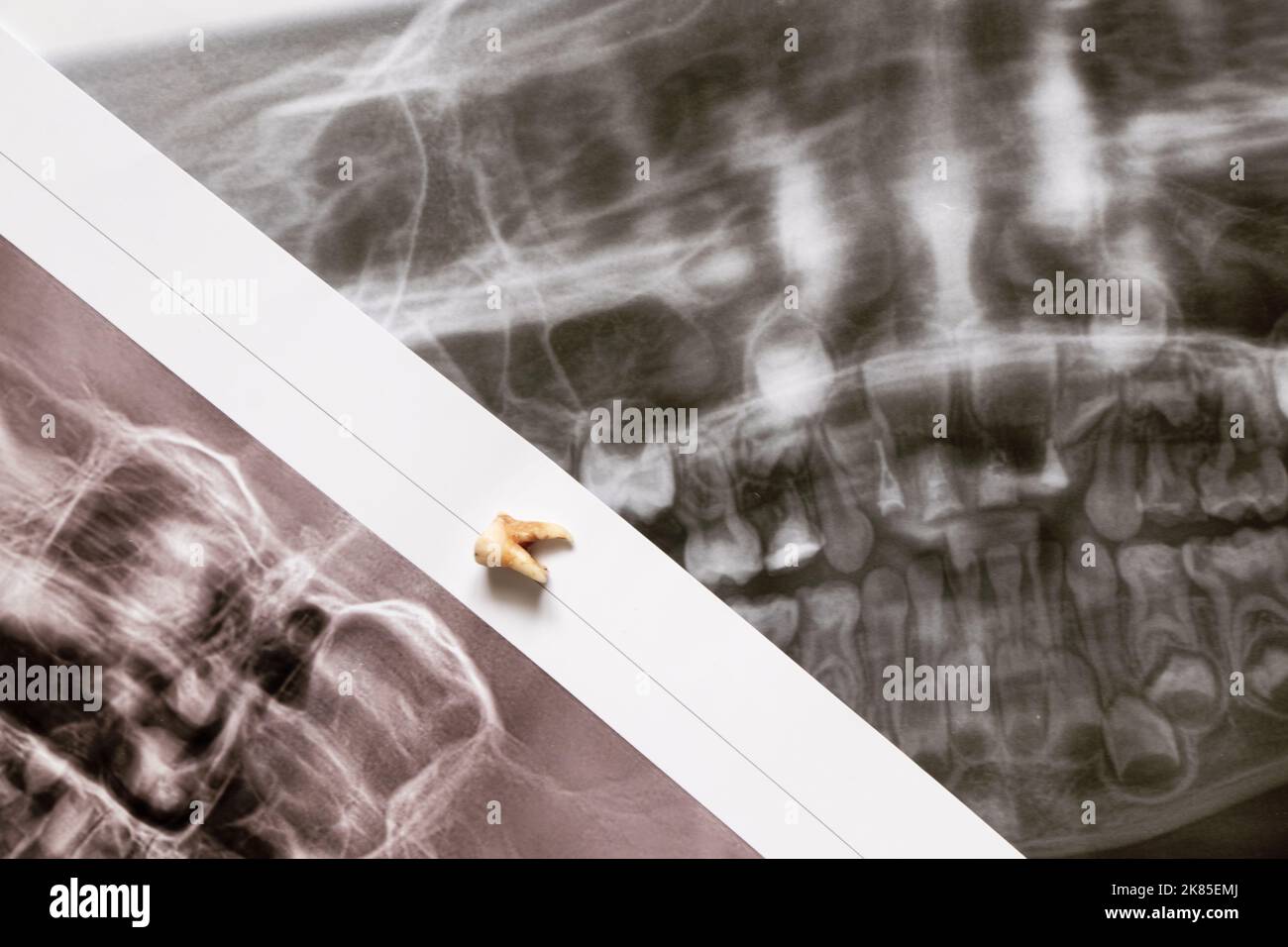 The panoramic image shows several embedded and impacted teeth as on the ...
