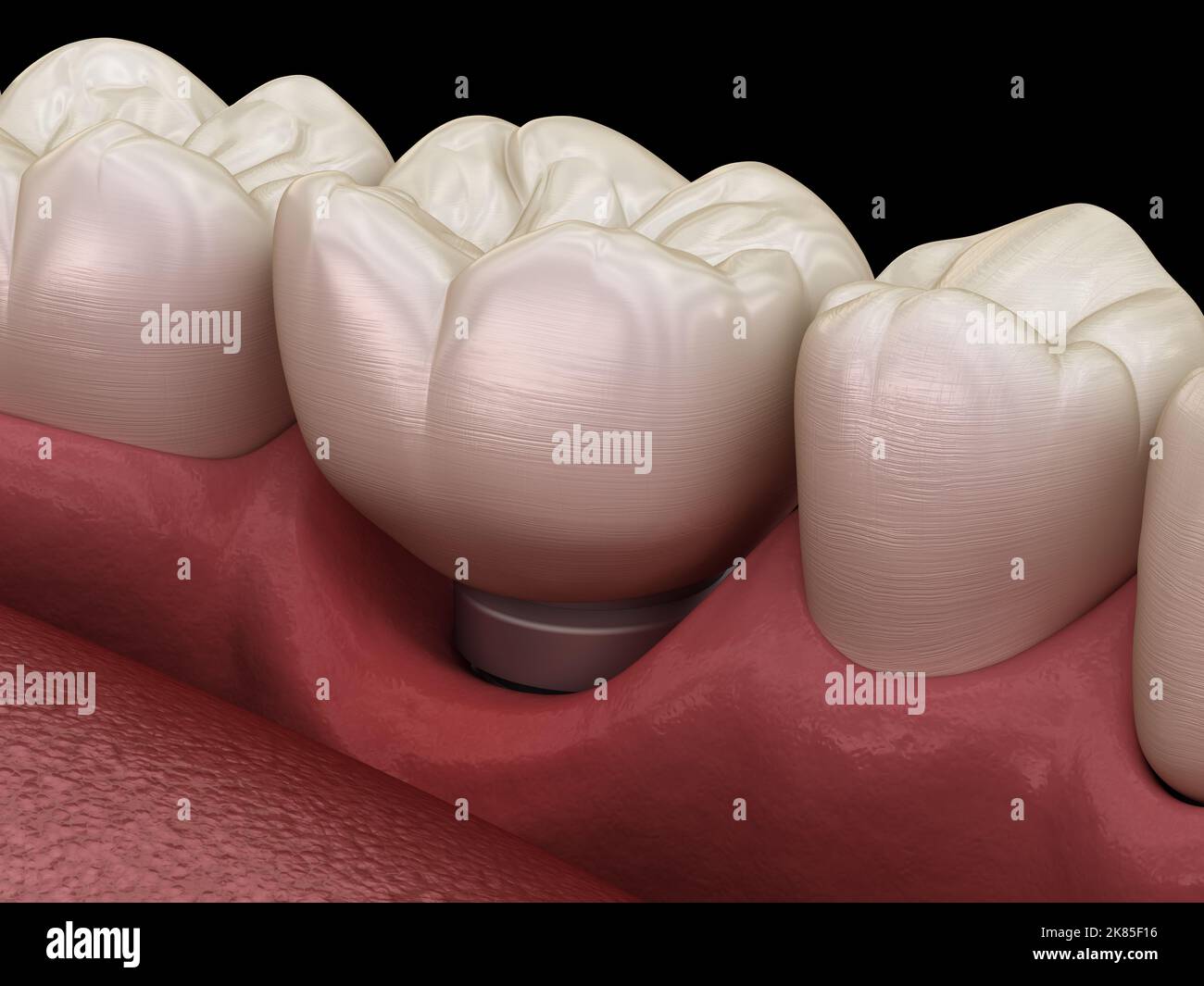 Peri Implantitis With Visible Gum Recession Medically Accurate 3d